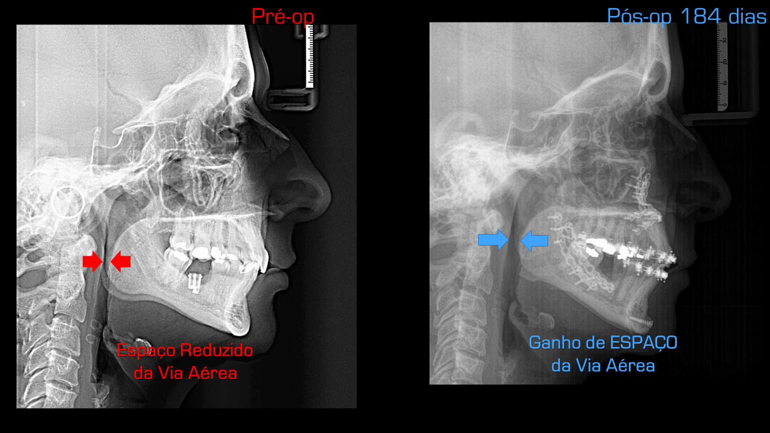 CIRURGIA ORTOGNÁTICA MINIMAMENTE INVASIVA E APNÉIA DO SONO: O que você precisa Saber ...